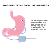 What Is Gastroparesis 