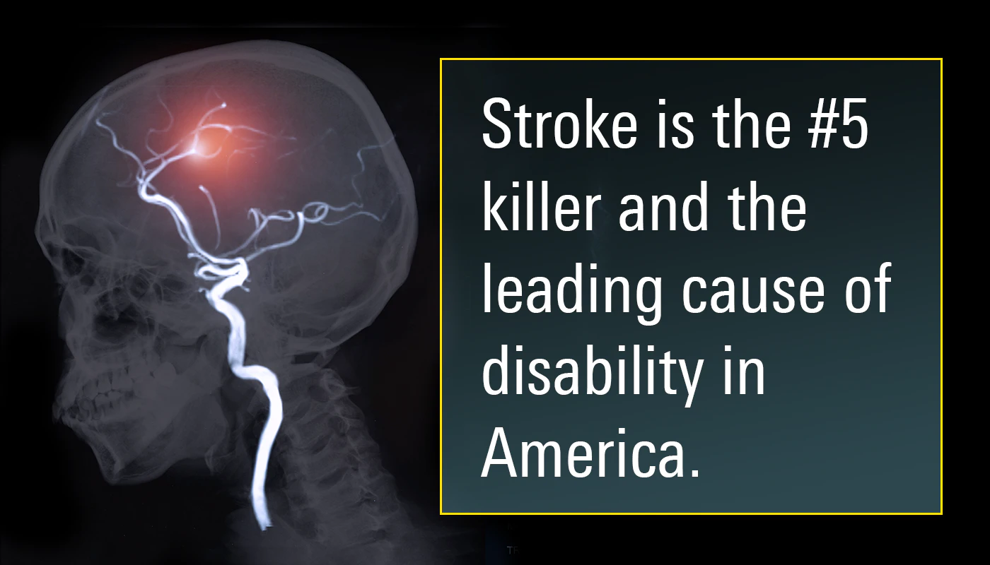 What is Stroke? | Risk Factors and Treatment